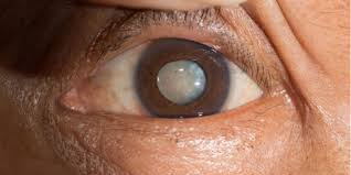 Cataract - creole translation, synonyms, pronunciation, definition ...