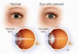 Cataract - creole translation, synonyms, pronunciation, definition ...