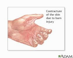 Contractures - somali translation, synonyms, pronunciation, definition ...